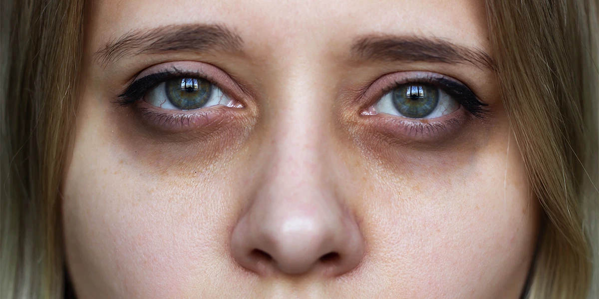 Causes of Dark Circles and Effective Treatments